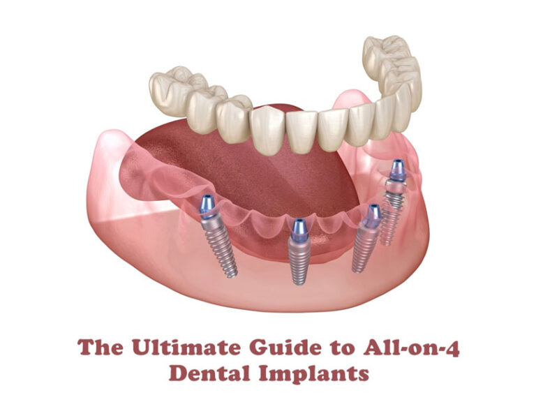 The Complete Guide to All-On-Four Implants: What to Expect Before and ...